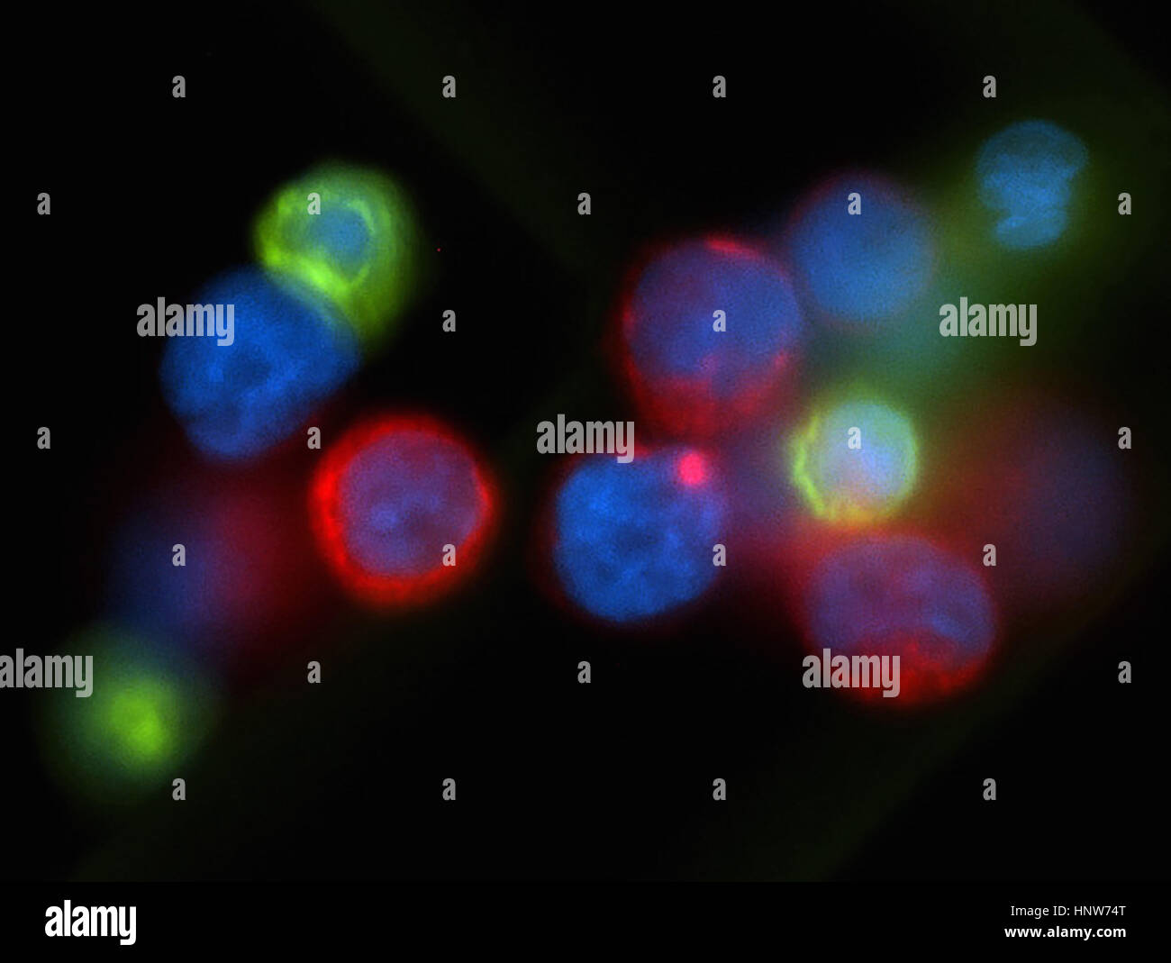 Microscopic image of circulating breast cancer cell cluster Stock Photo ...