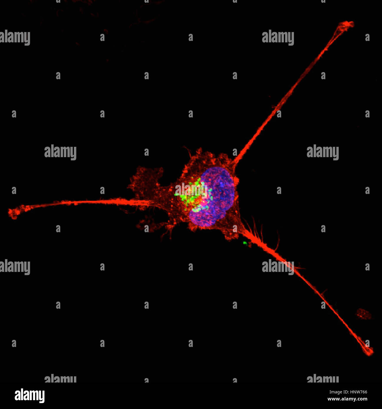 Triple negative breast cancer cell undergoing retraction and apoptosis ...