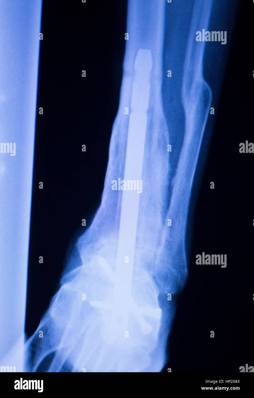 Xray foot heel ankle test scan results showing orthopedic titanium ...