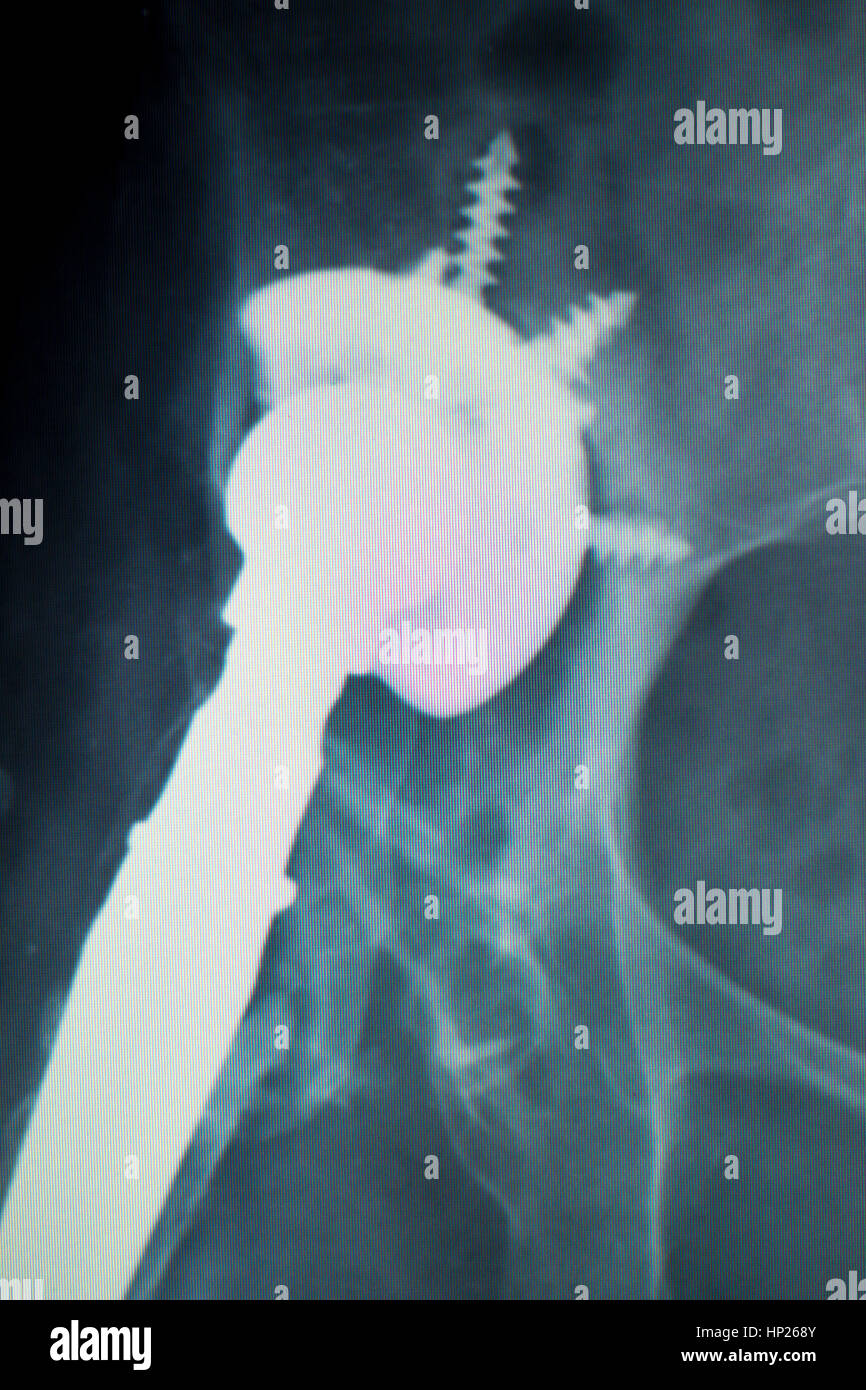 Orthopedics knee joint titanium modern metal implant replacement with ...