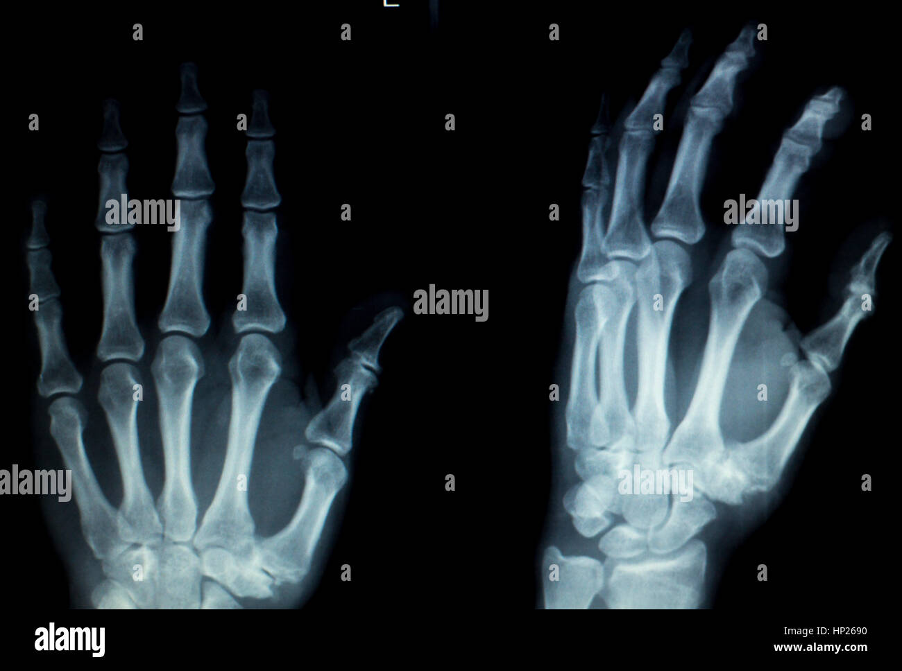 Orthopedics Hand finger joint meniscus, ligament, tendon and cartilage ...