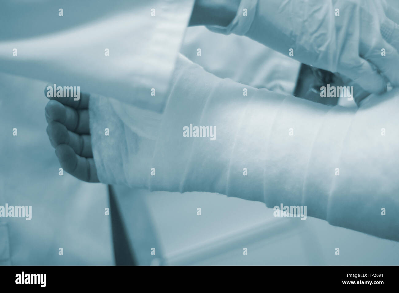 Plaster After Wrist Fracture Stock Photos & Plaster After Wrist ...