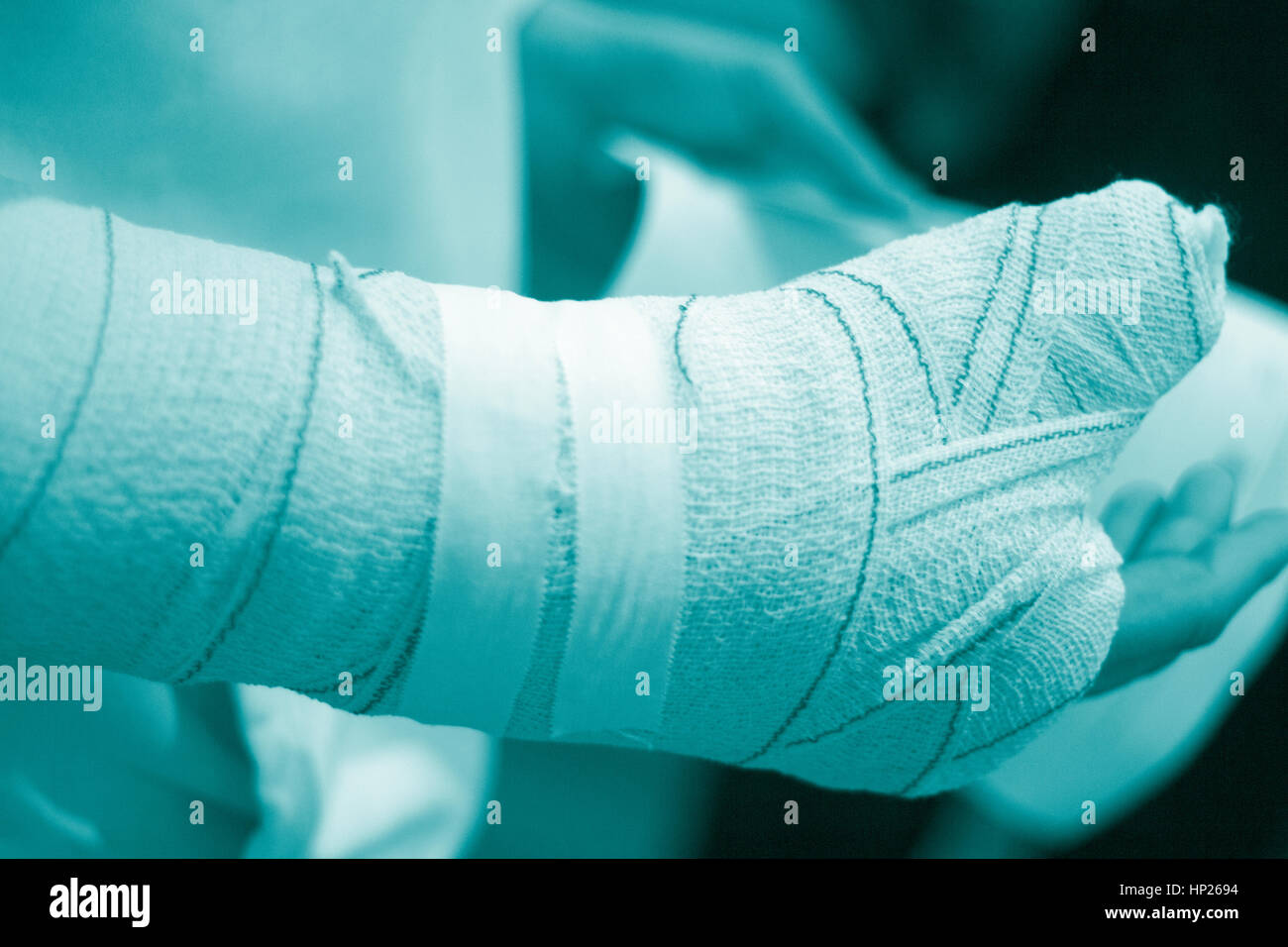 Plaster after wrist fracture hi-res stock photography and images - Alamy
