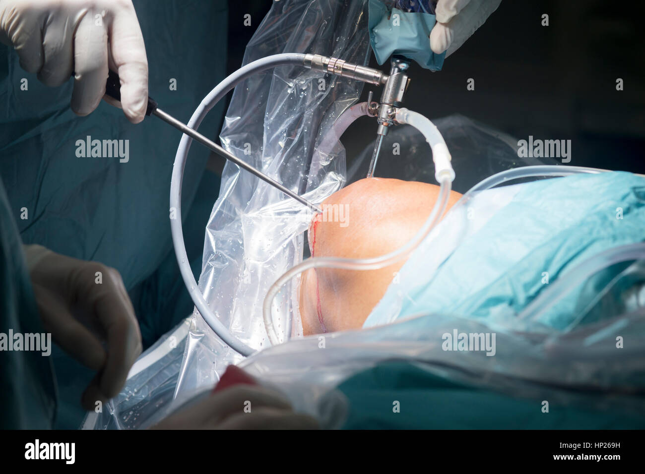 Knee keyhole surgery hospital arthroscopy operation medical procedure ...