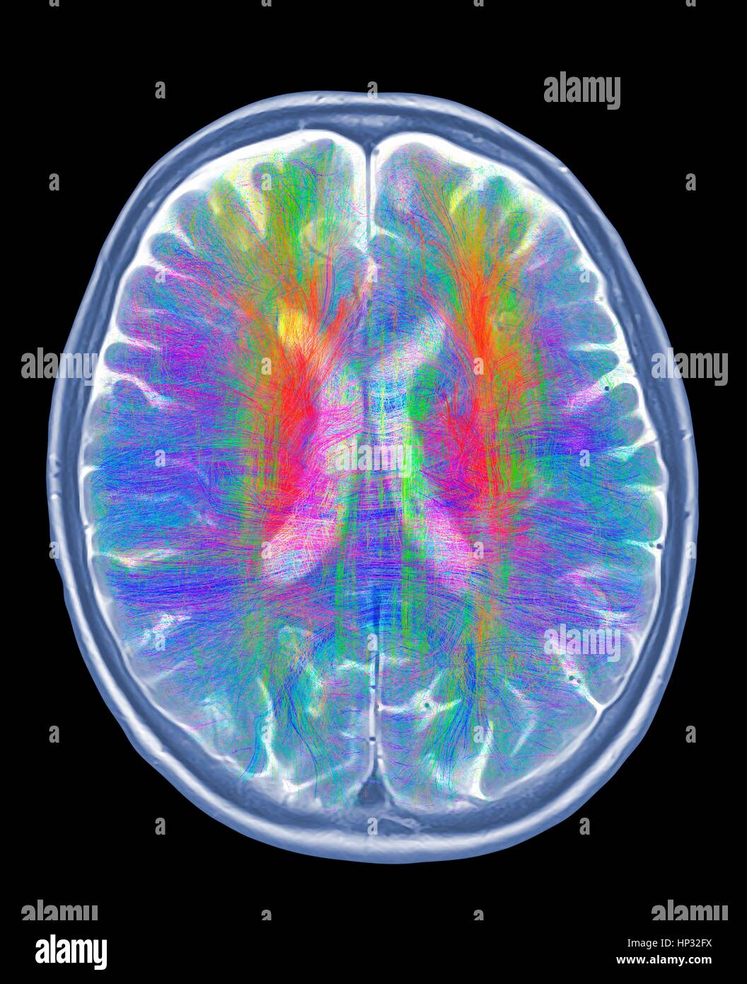 Diffusion mri hi-res stock photography and images - Alamy