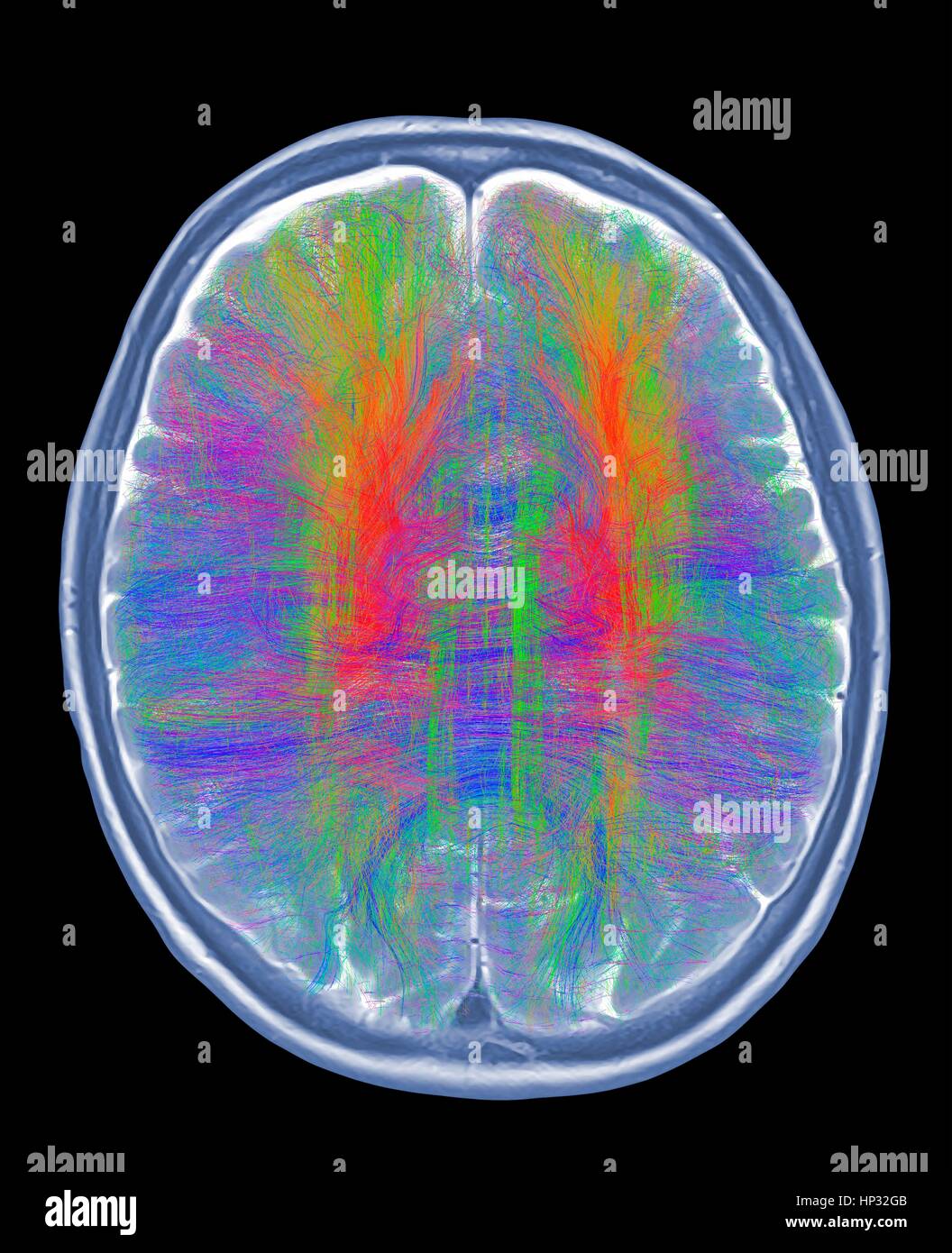 Diffusion mri hi-res stock photography and images - Alamy