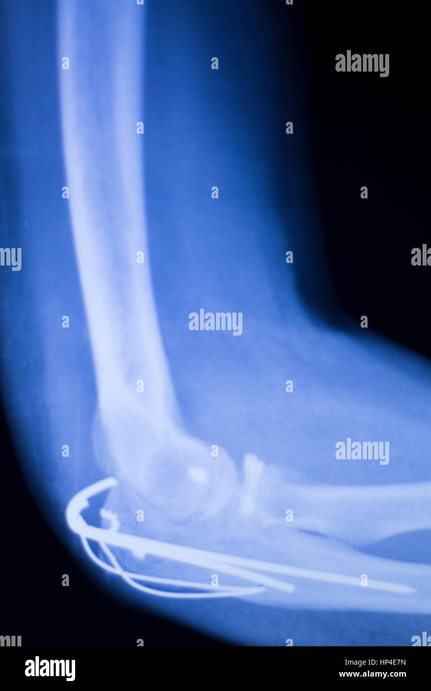 Elbow joint titanium metal modern implant x-ray test scan result after ...