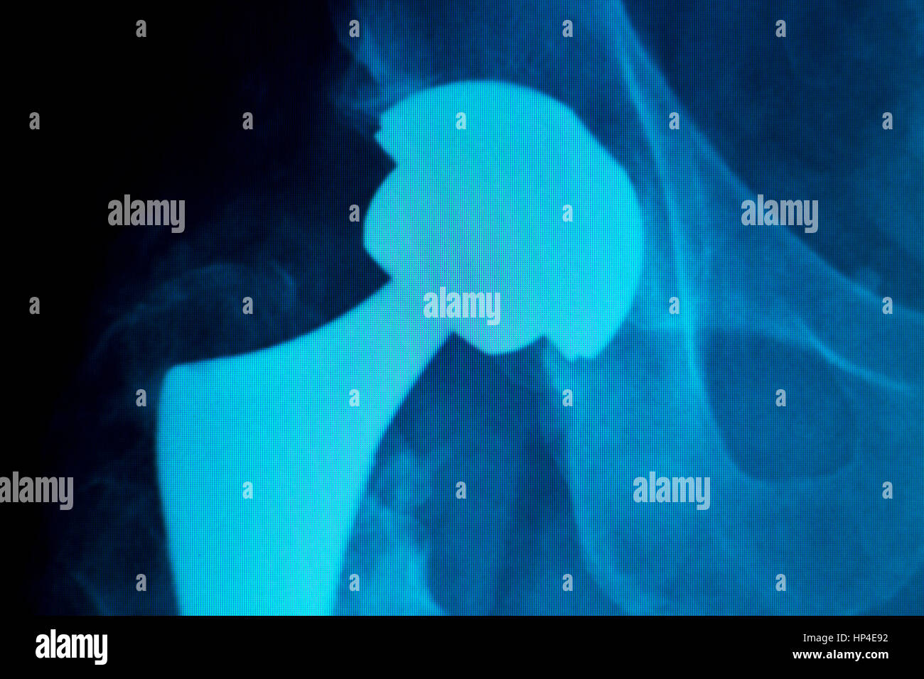 Orthopedics knee joint titanium modern metal implant replacement with ...