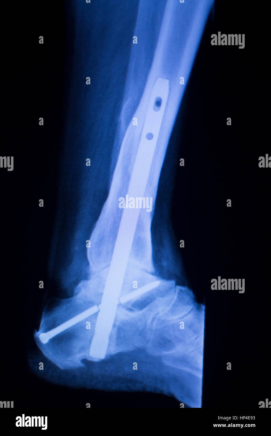 Xray foot heel ankle test scan results showing orthopedic titanium ...