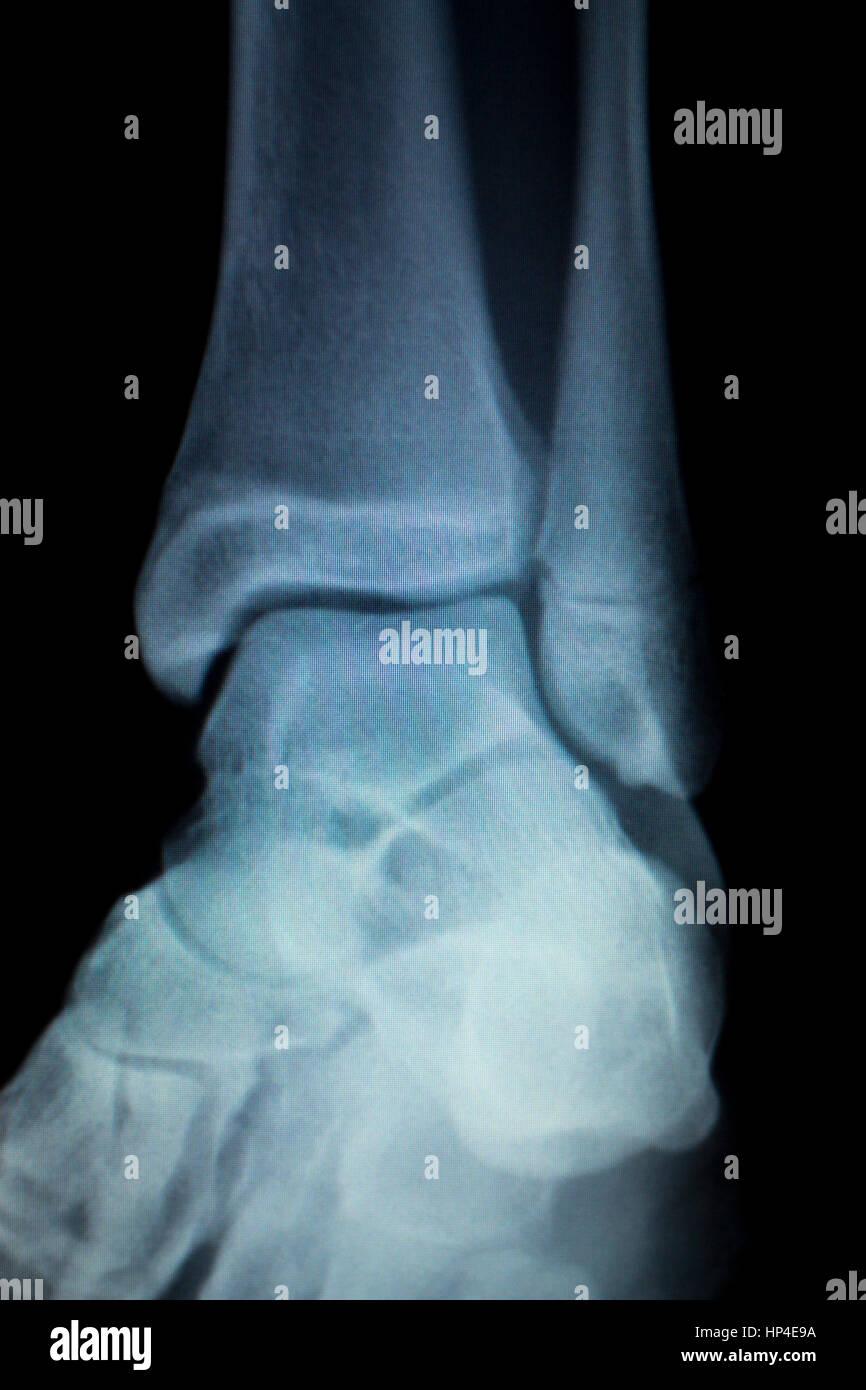 Xray foot heel ankle test scan results showing orthopedic titanium ...