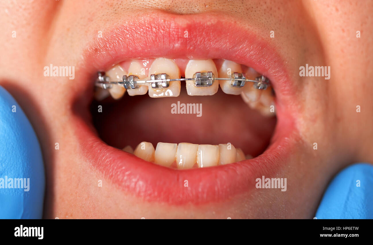 Brackets people human human hi-res stock photography and images - Alamy
