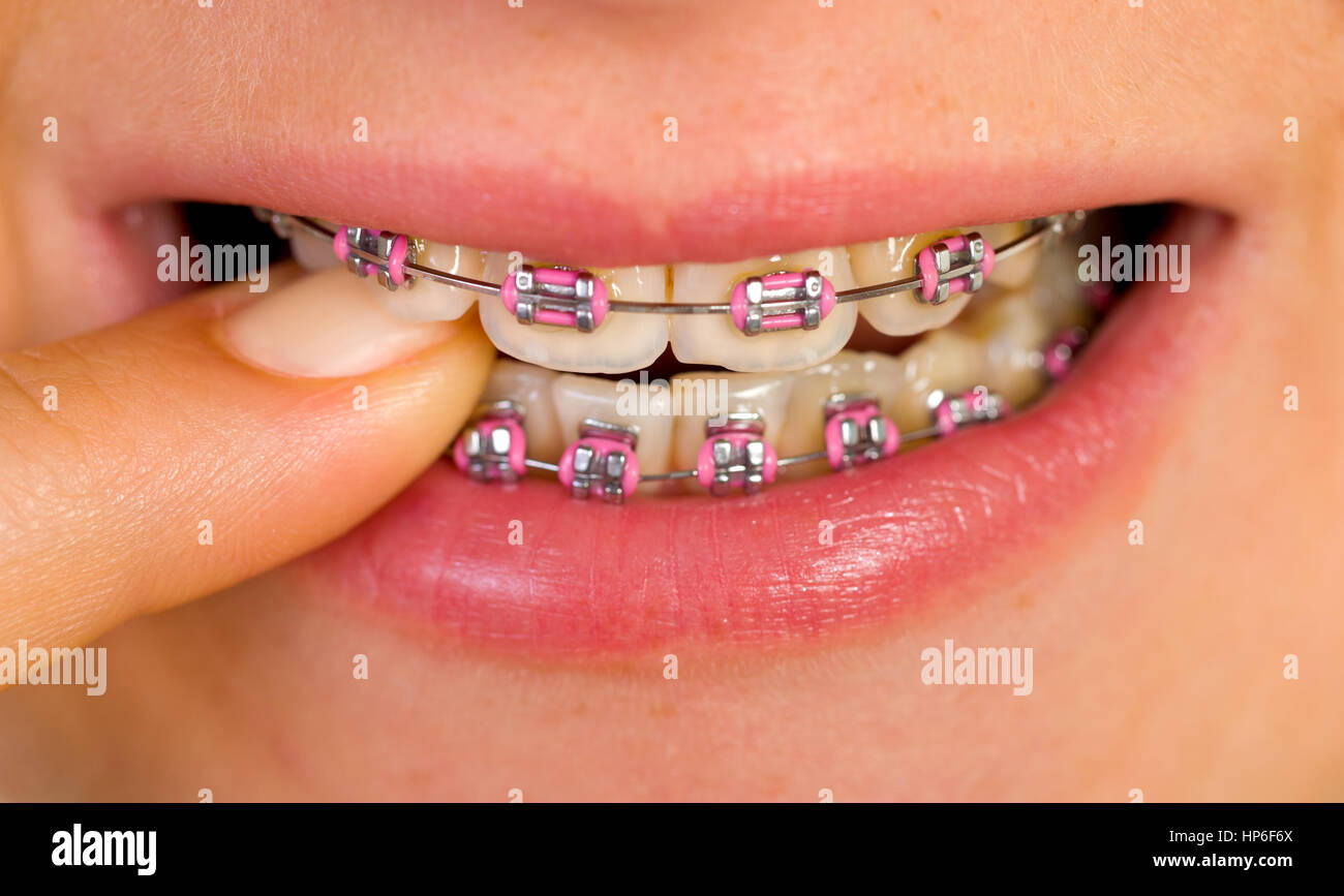 Brackets fix hi-res stock photography and images - Alamy