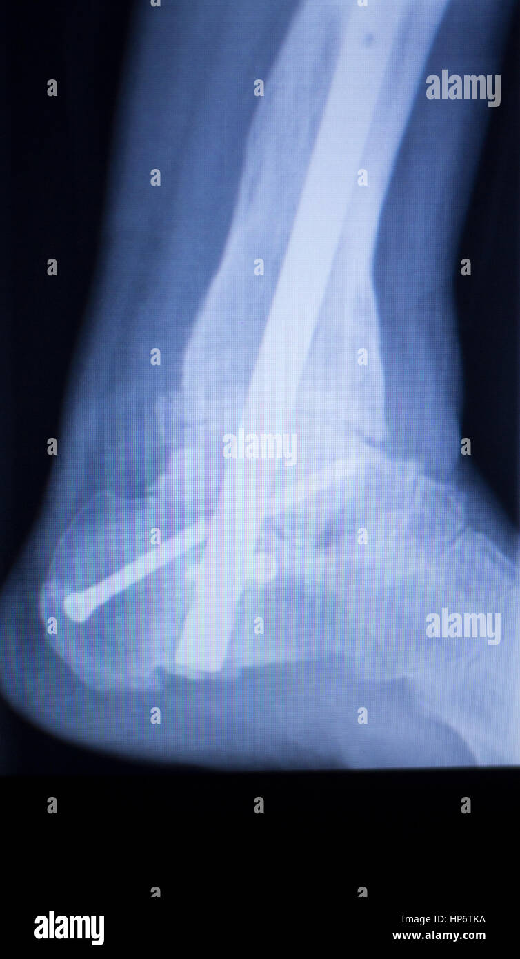 Xray foot heel ankle test scan results showing orthopedic titanium ...