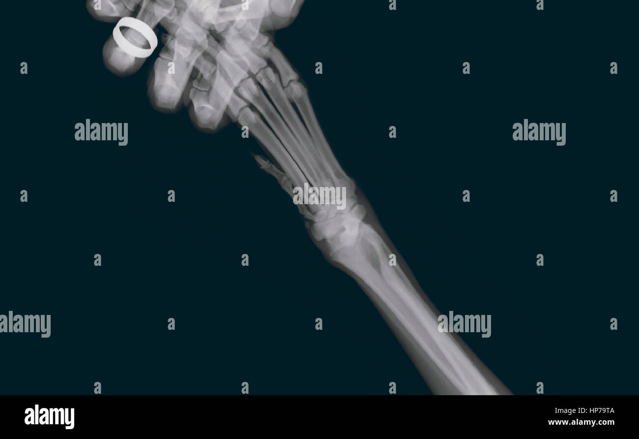 Foot Xray Stock Photos & Foot Xray Stock Images - Alamy