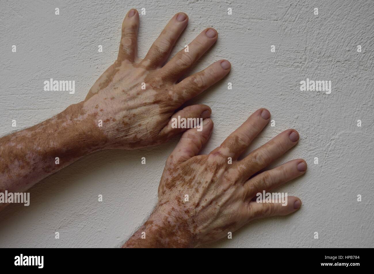 Vitiligo skin condition Stock Photo - Alamy