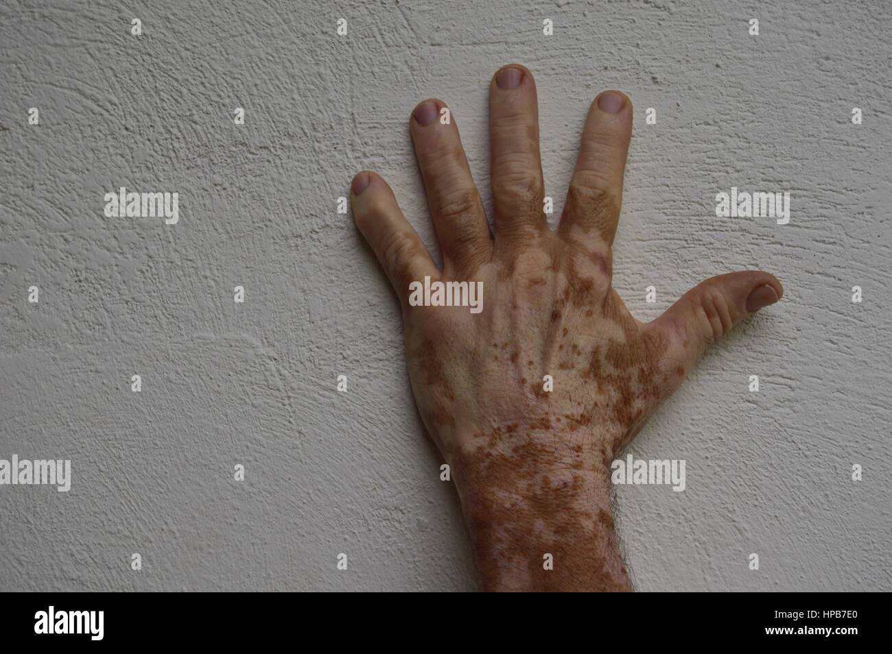Vitiligo skin condition Stock Photo - Alamy