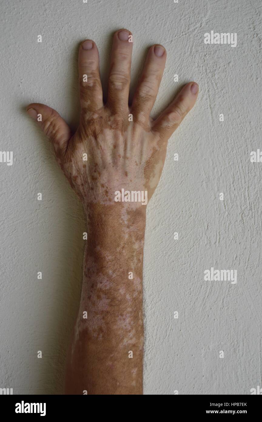 Vitiligo skin condition Stock Photo - Alamy