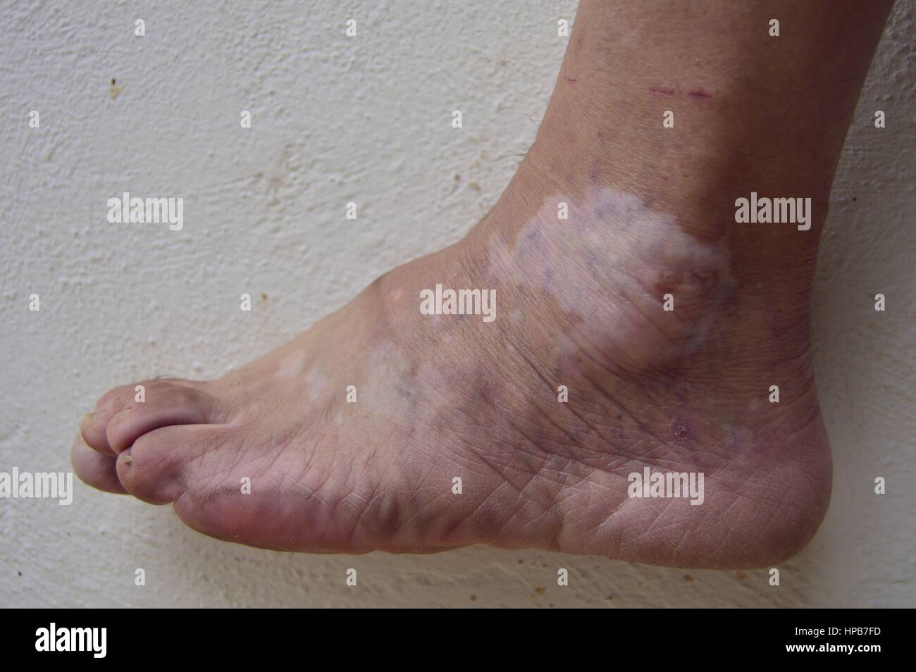 Vitiligo skin condition Stock Photo - Alamy