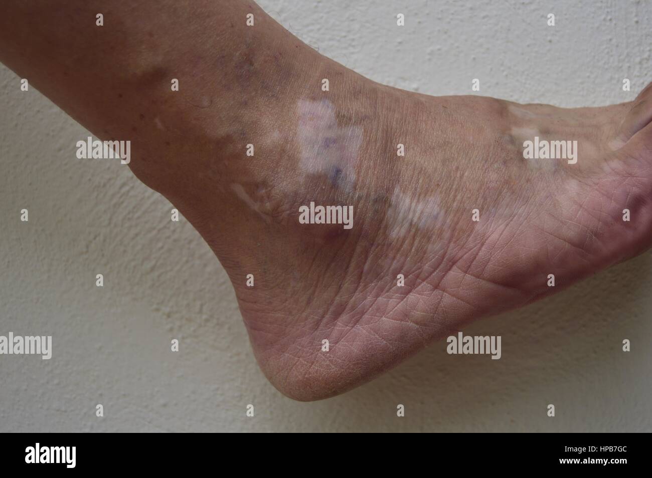 Vitiligo skin condition Stock Photo - Alamy