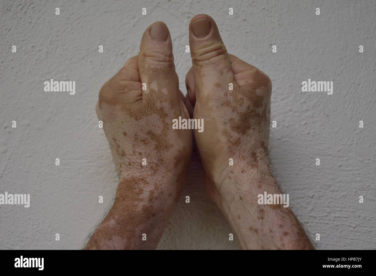 Vitiligo skin condition Stock Photo - Alamy