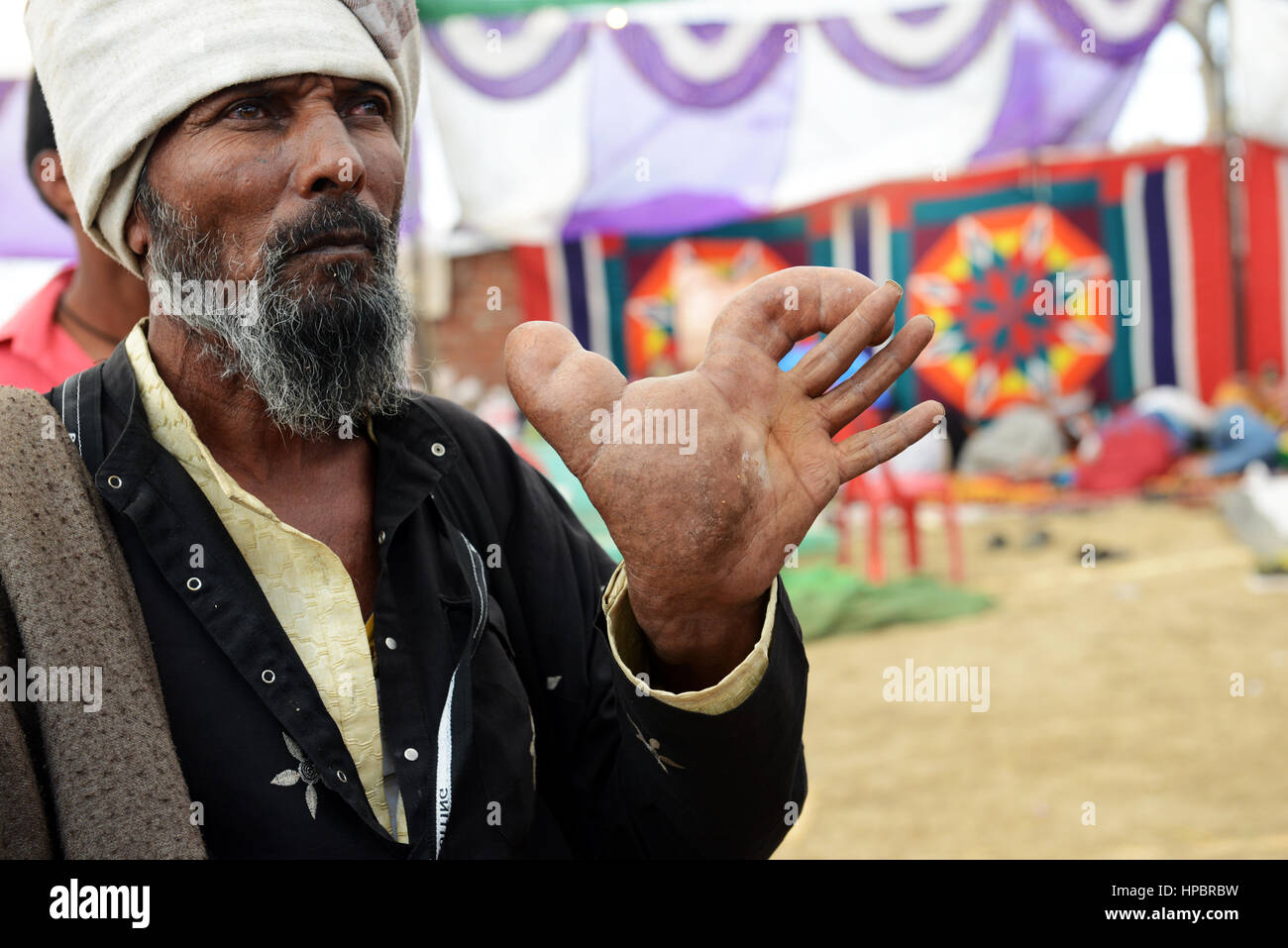 Elephantiasis hi-res stock photography and images - Alamy