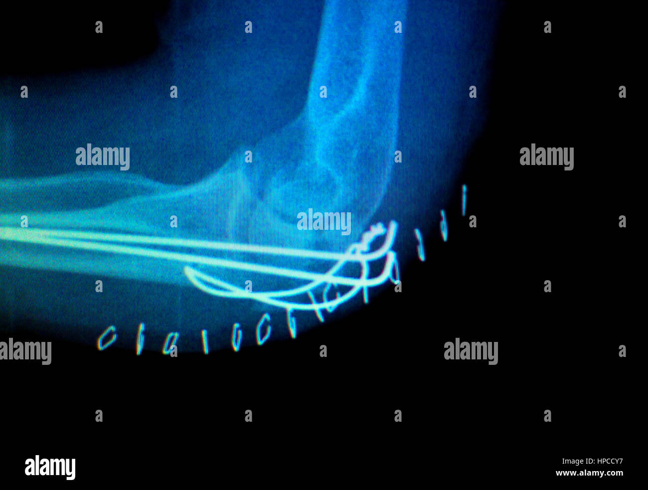Elbow joint titanium metal modern implant x-ray test scan result after ...