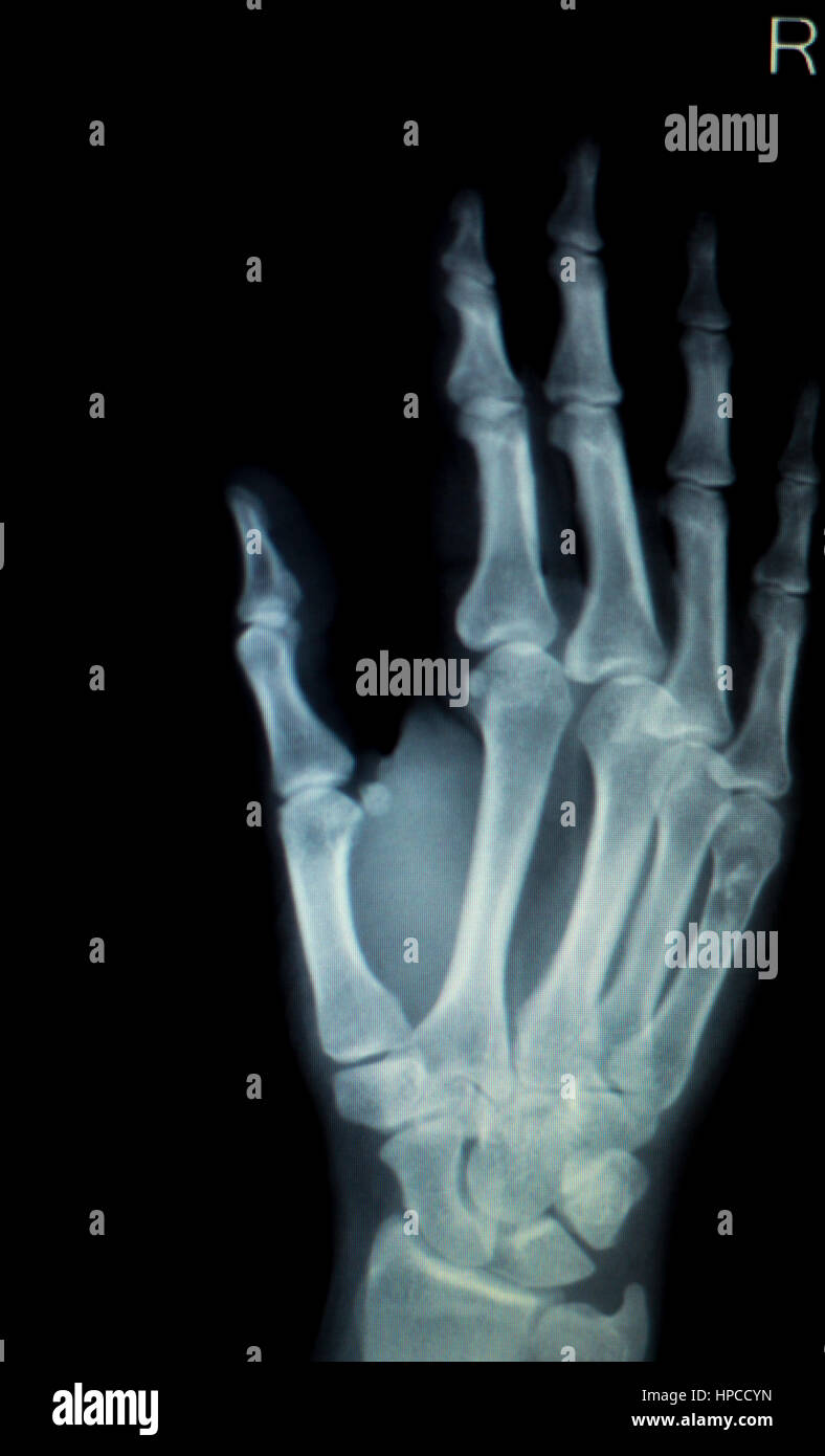 Orthopedics Hand finger joint meniscus, ligament, tendon and cartilage ...