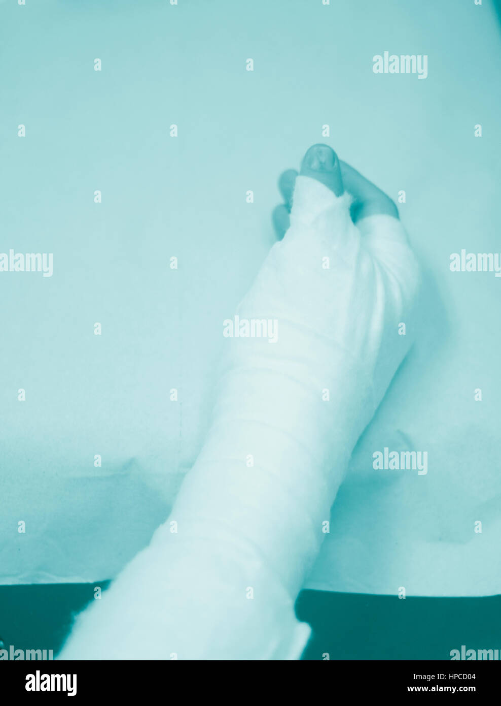 Doctor applying a plaster cast and bandages to patient forearm and ...