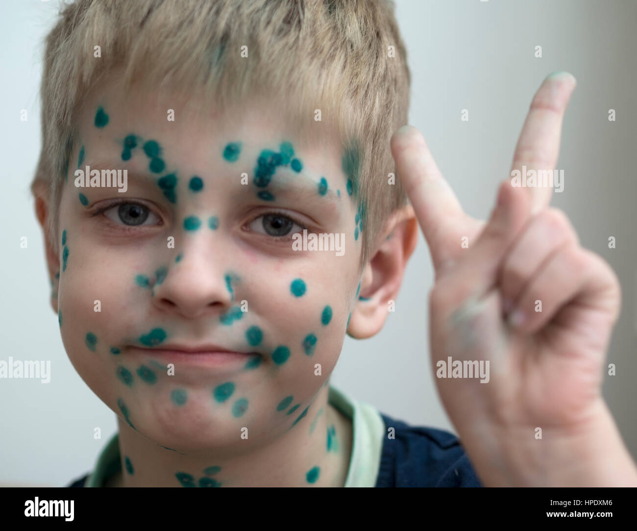 Varicella zoster virus or Chickenpox bubble rash on child, baby or ...