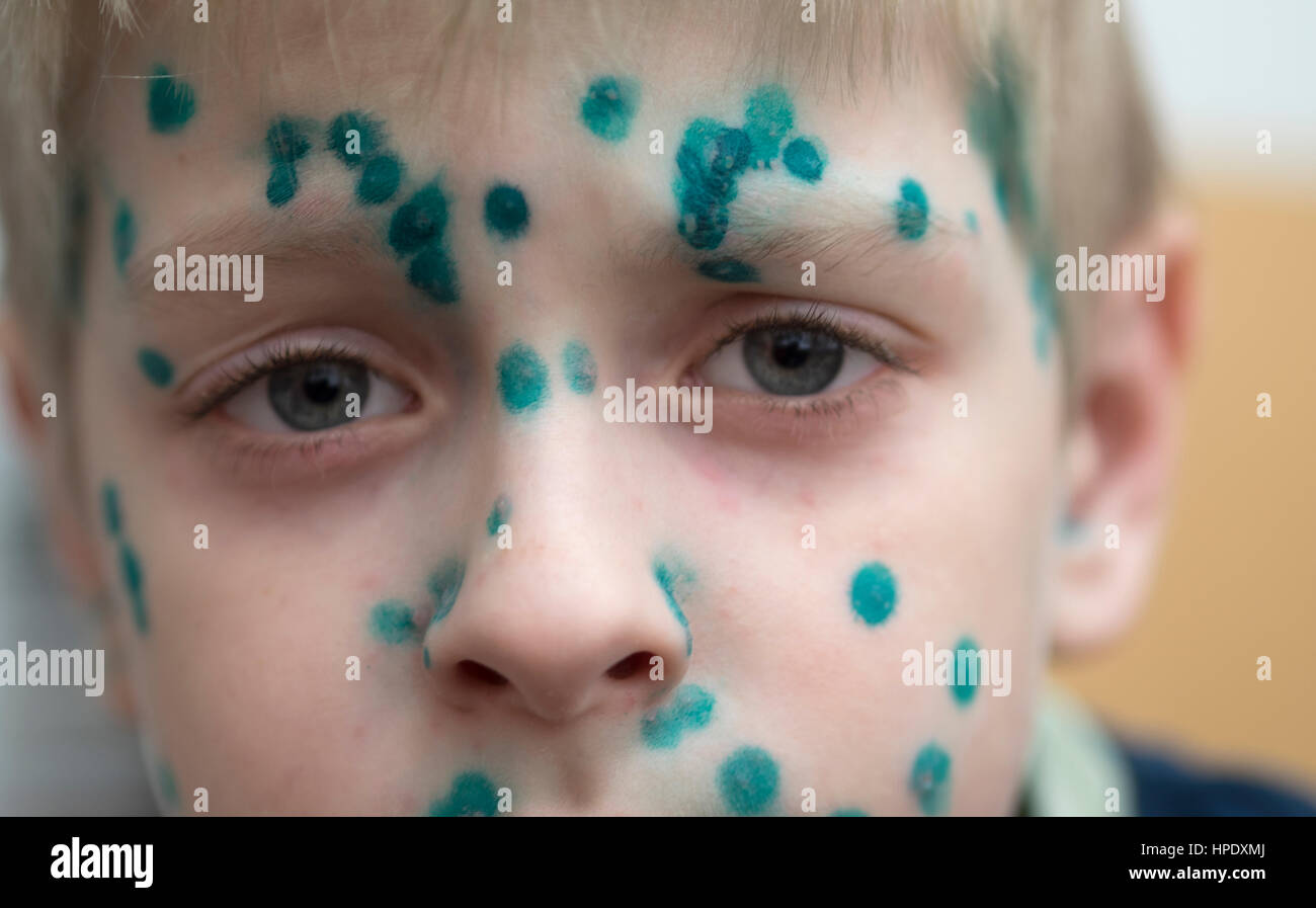 Varicella zoster virus or Chickenpox bubble rash on child, baby or ...