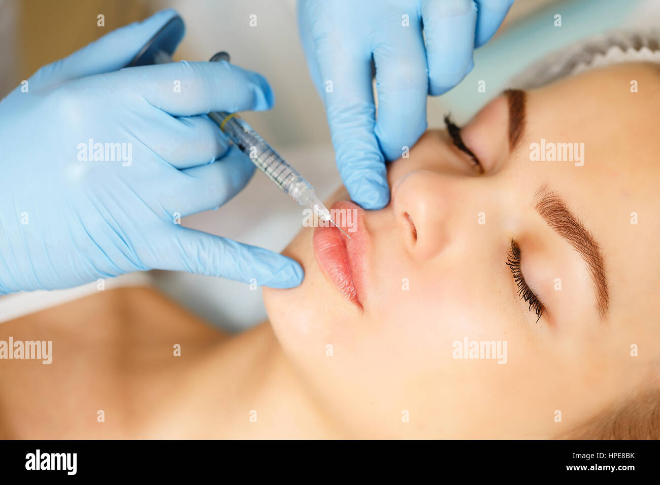 Injections of the lips. Correction form the upper lip. Injection of ...