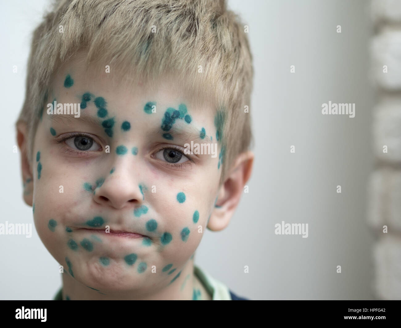 Varicella zoster virus or Chickenpox bubble rash on child, baby or ...