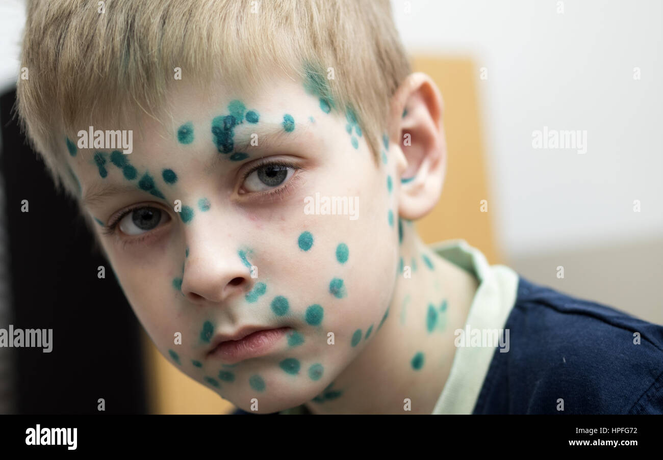 Varicella zoster virus or Chickenpox bubble rash on child, baby or ...