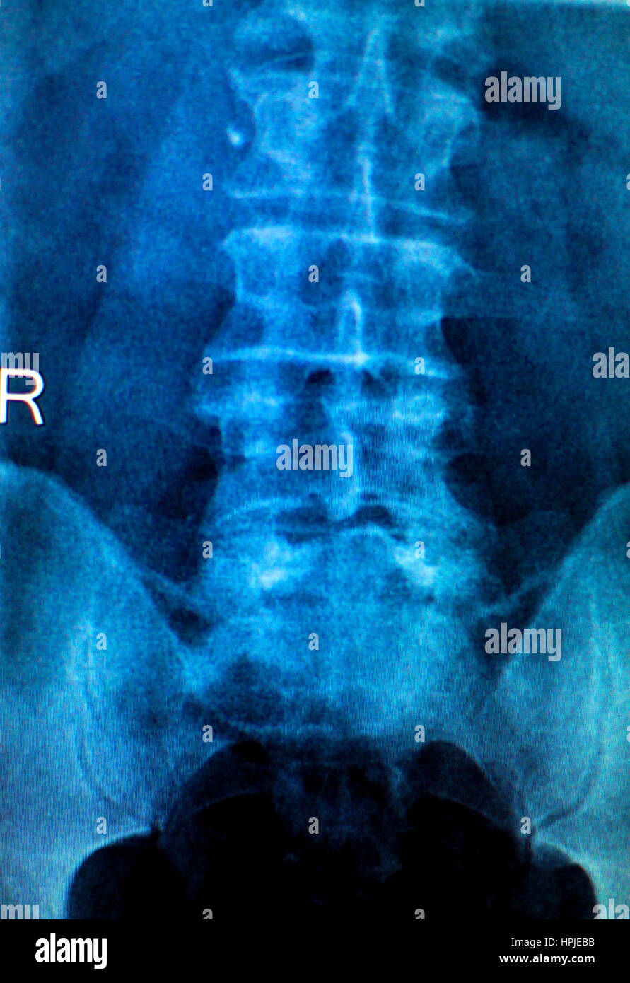 Orthopedics Lower Spine Pelvis And Hips X Ray Scan Test Results For