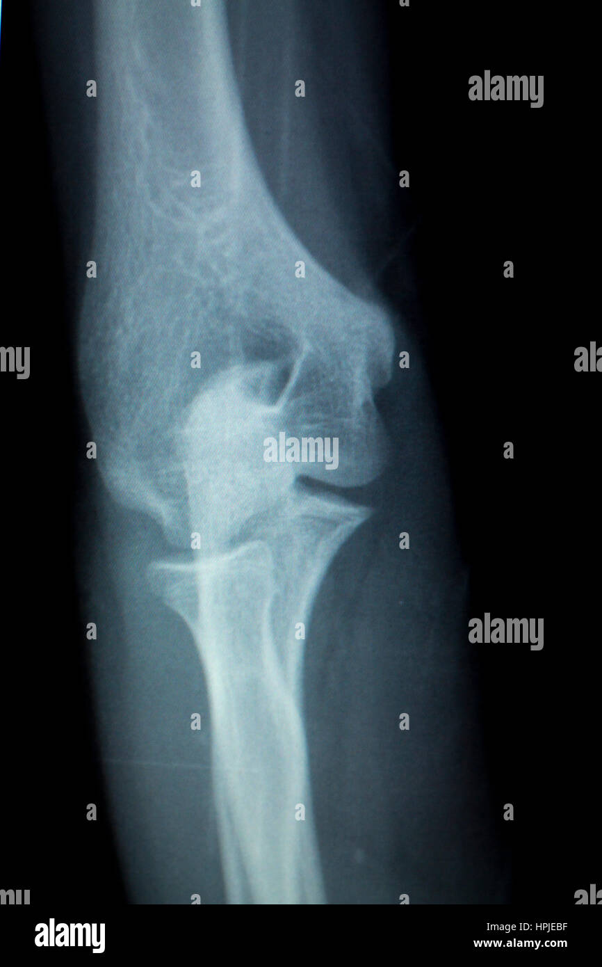 Tennis Elbow X Ray