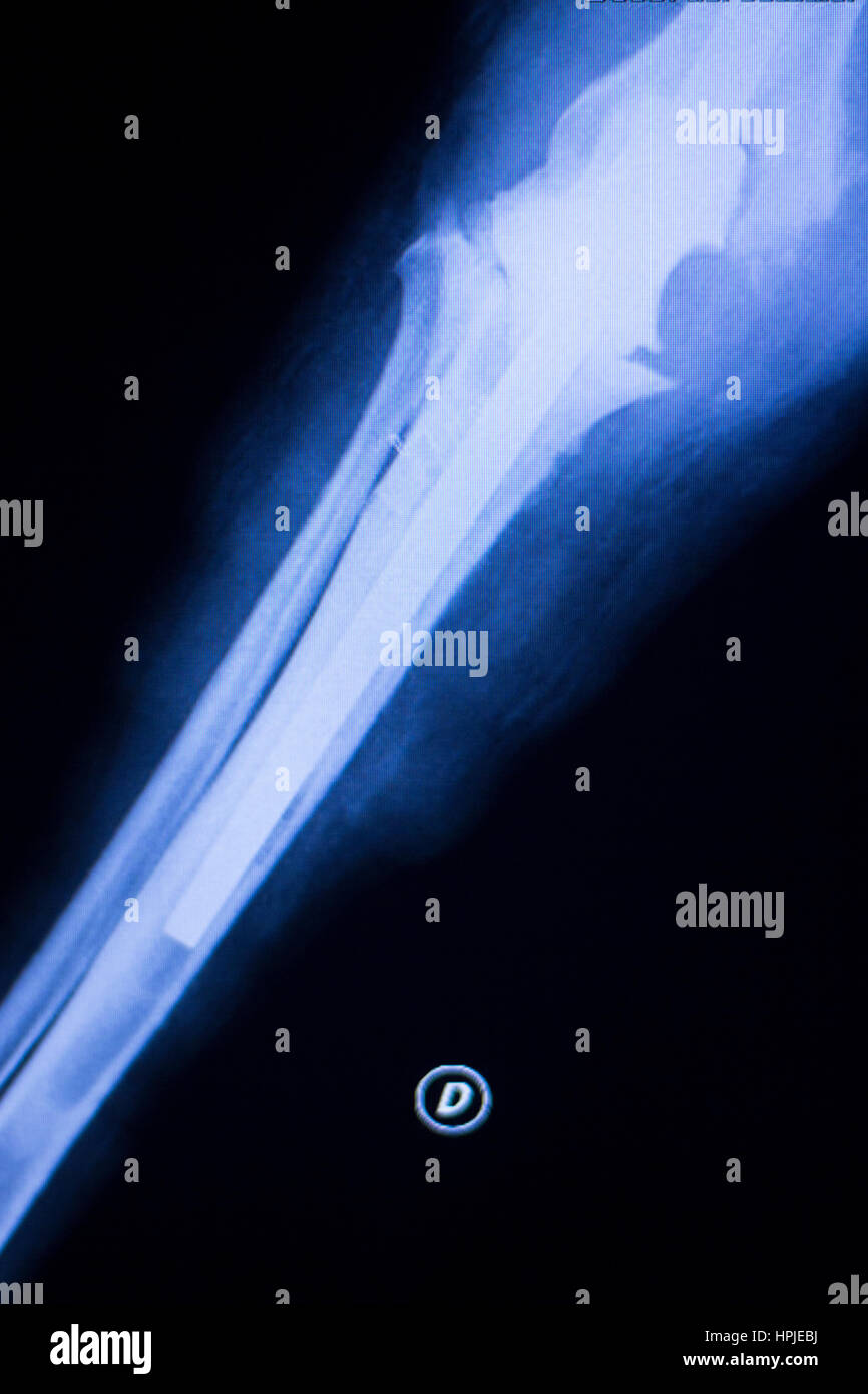 Elbow joint titanium metal modern implant x-ray test scan result after ...