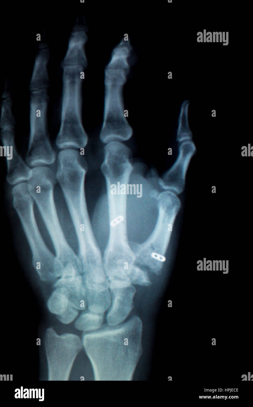 Orthopedics Hand finger joint meniscus, ligament, tendon and cartilage ...