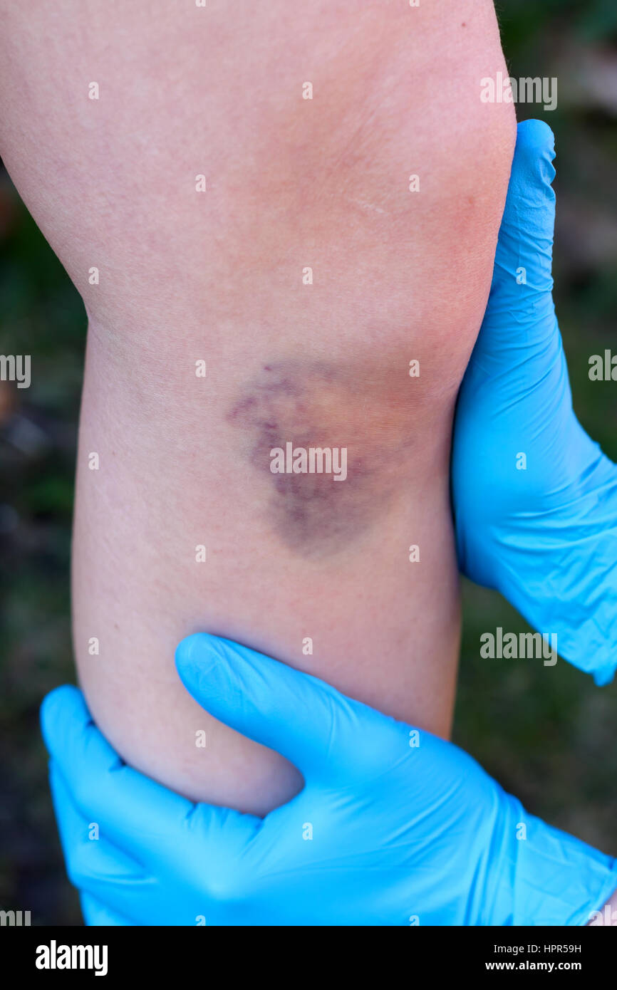 Close up of a knee with hematoma Stock Photo - Alamy