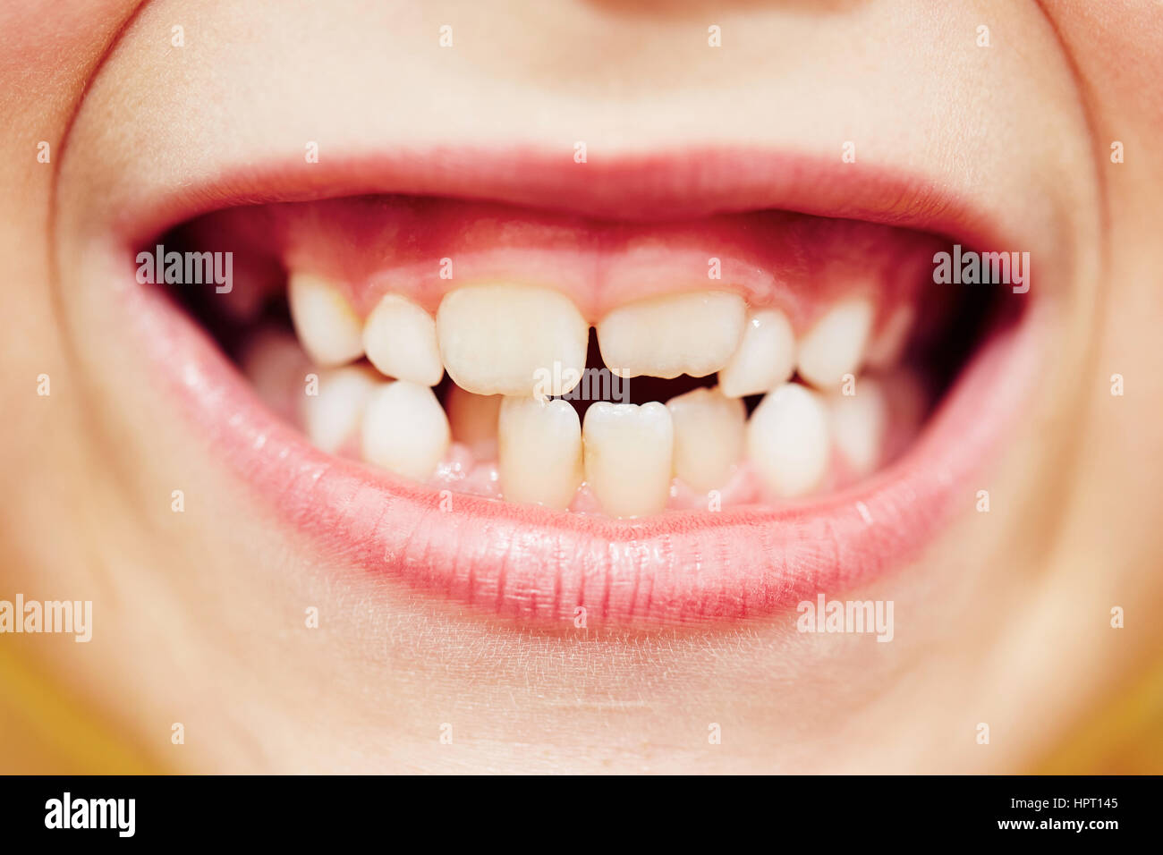 First and second teeth of the little boy Stock Photo - Alamy