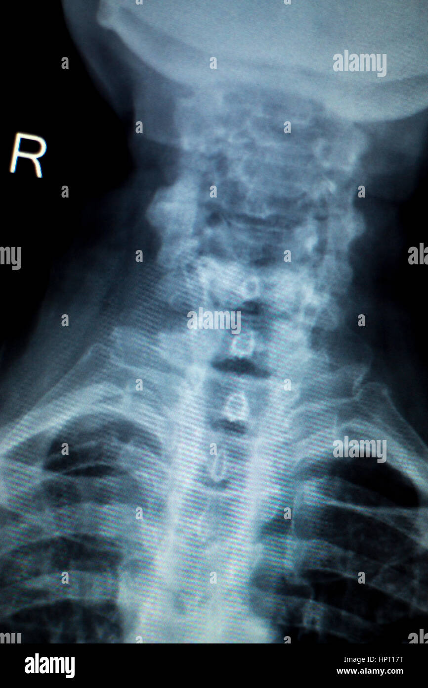 Orthopedics upper spine and neck X-ray scan test results for old age ...