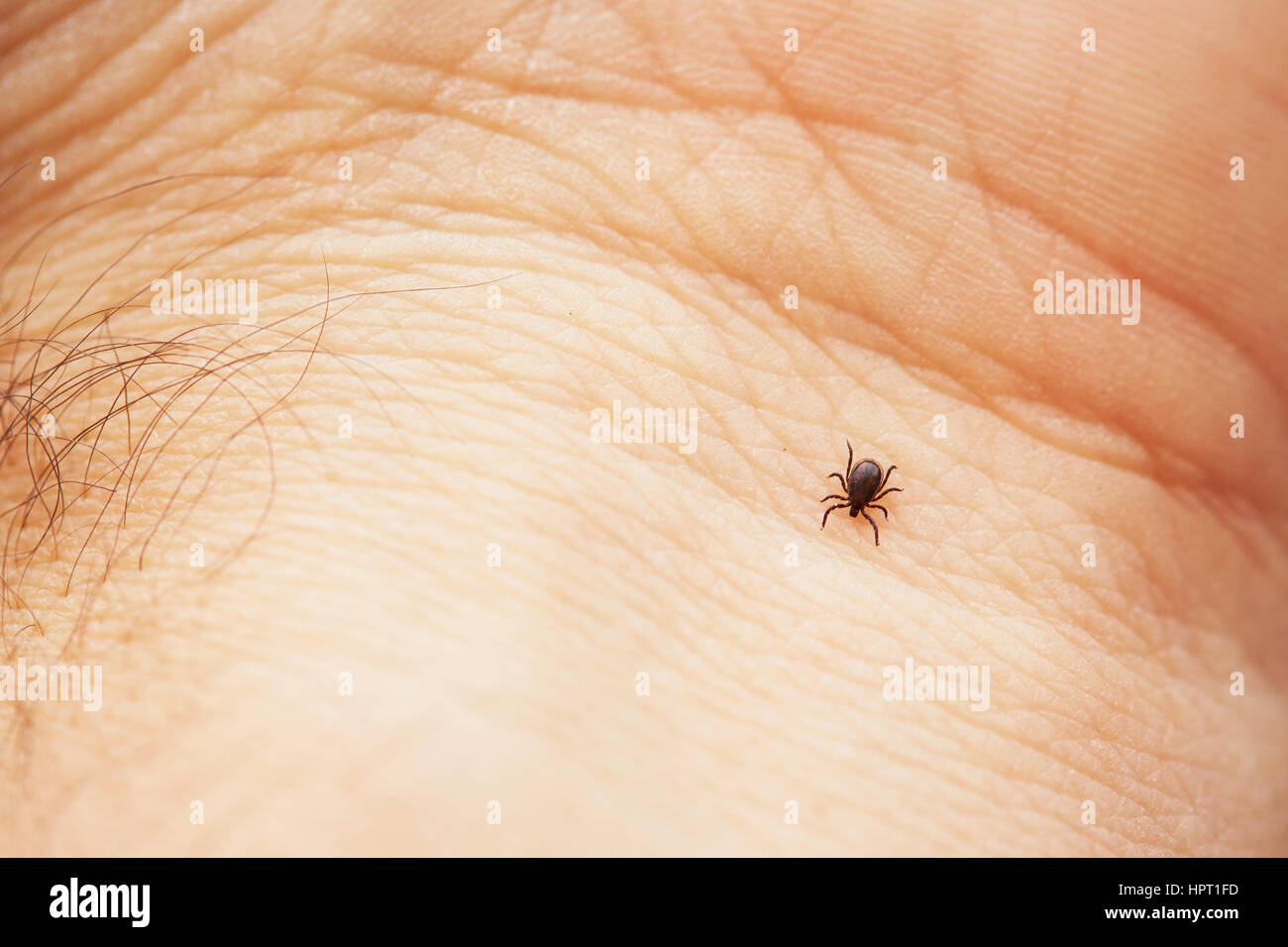 Tick human hair hi-res stock photography and images - Alamy