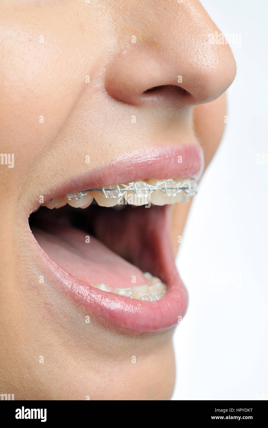 Close-up of ceramic and metallic braces on teeth. Orthodontic Treatment ...