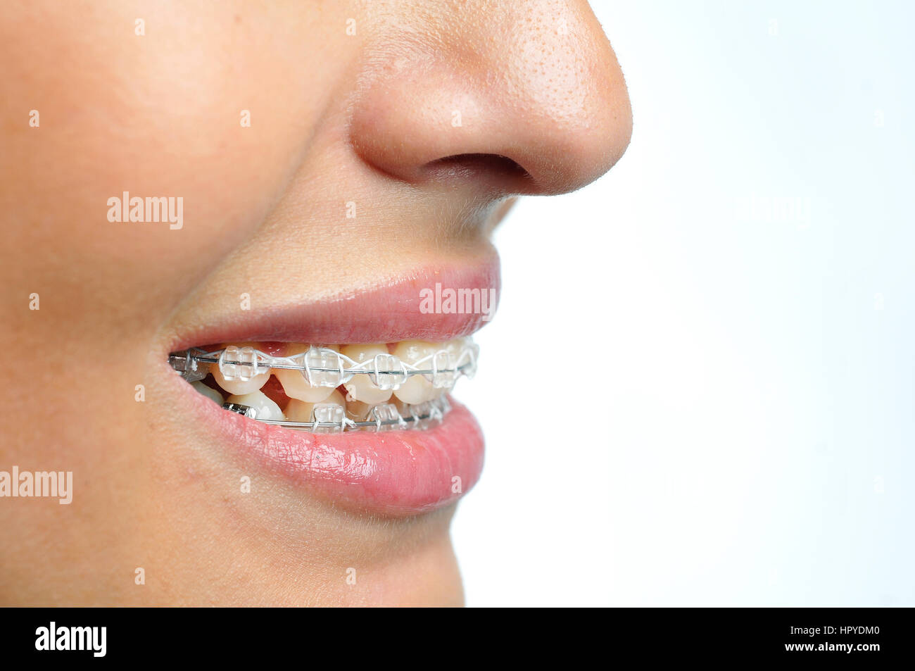 Close-up of ceramic and metallic braces on teeth. Orthodontic Treatment ...