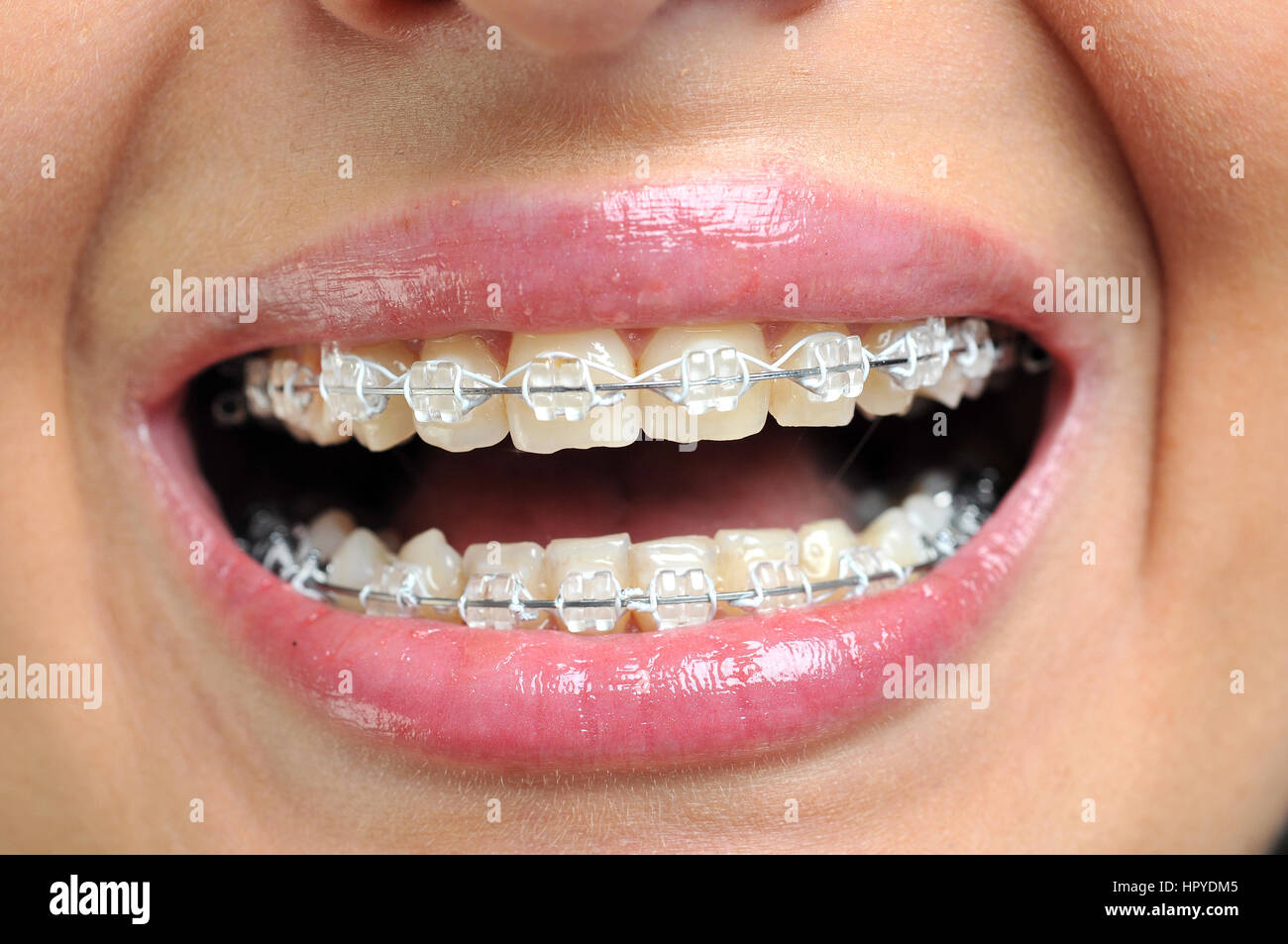 Close-up of ceramic and metallic braces on teeth. Orthodontic Treatment ...