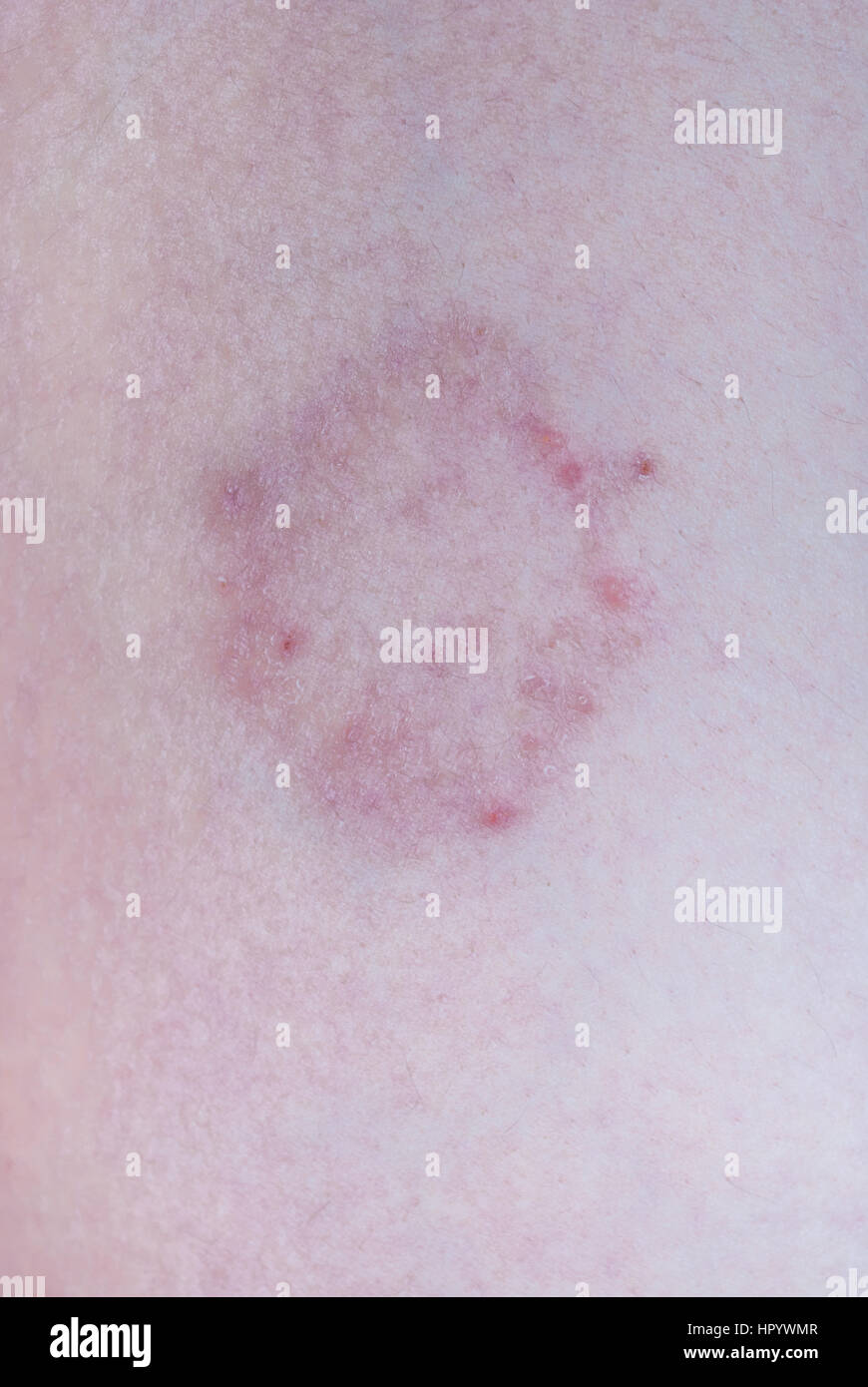 Closeup to First Step of Dermatophytosis/ Ringworm Symptom on Skin ...