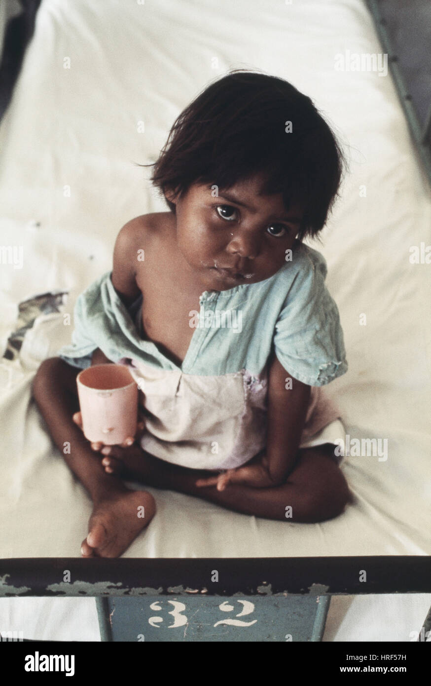 Marasmus hi-res stock photography and images - Alamy