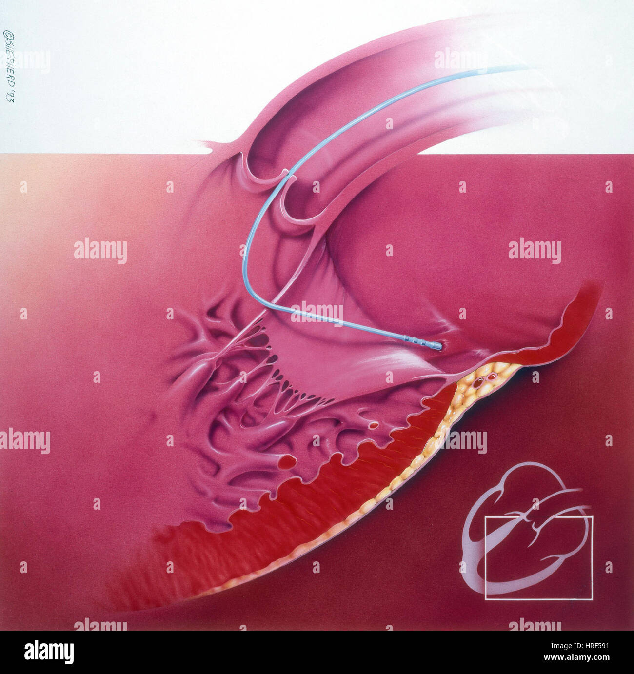 Catheter ablation hi-res stock photography and images - Alamy