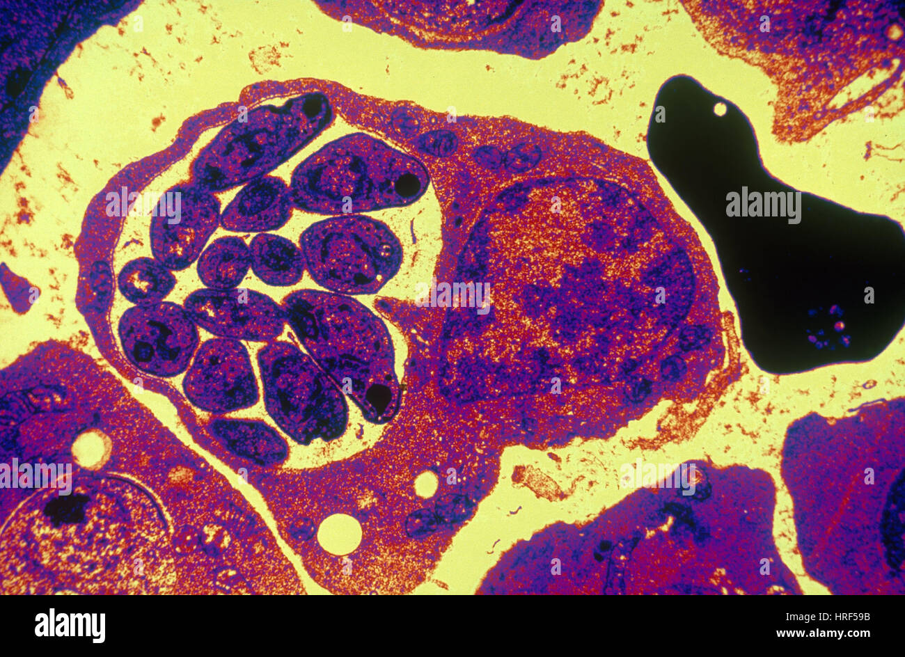 Malaria pathology hi-res stock photography and images - Alamy