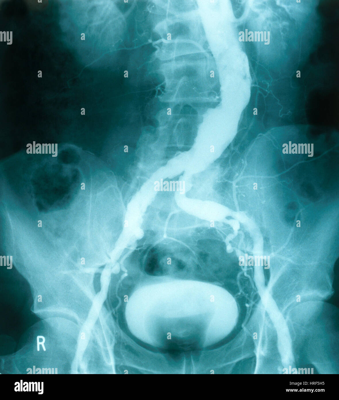 Atheroma in Aorta and Iliac Arteries Stock Photo - Alamy