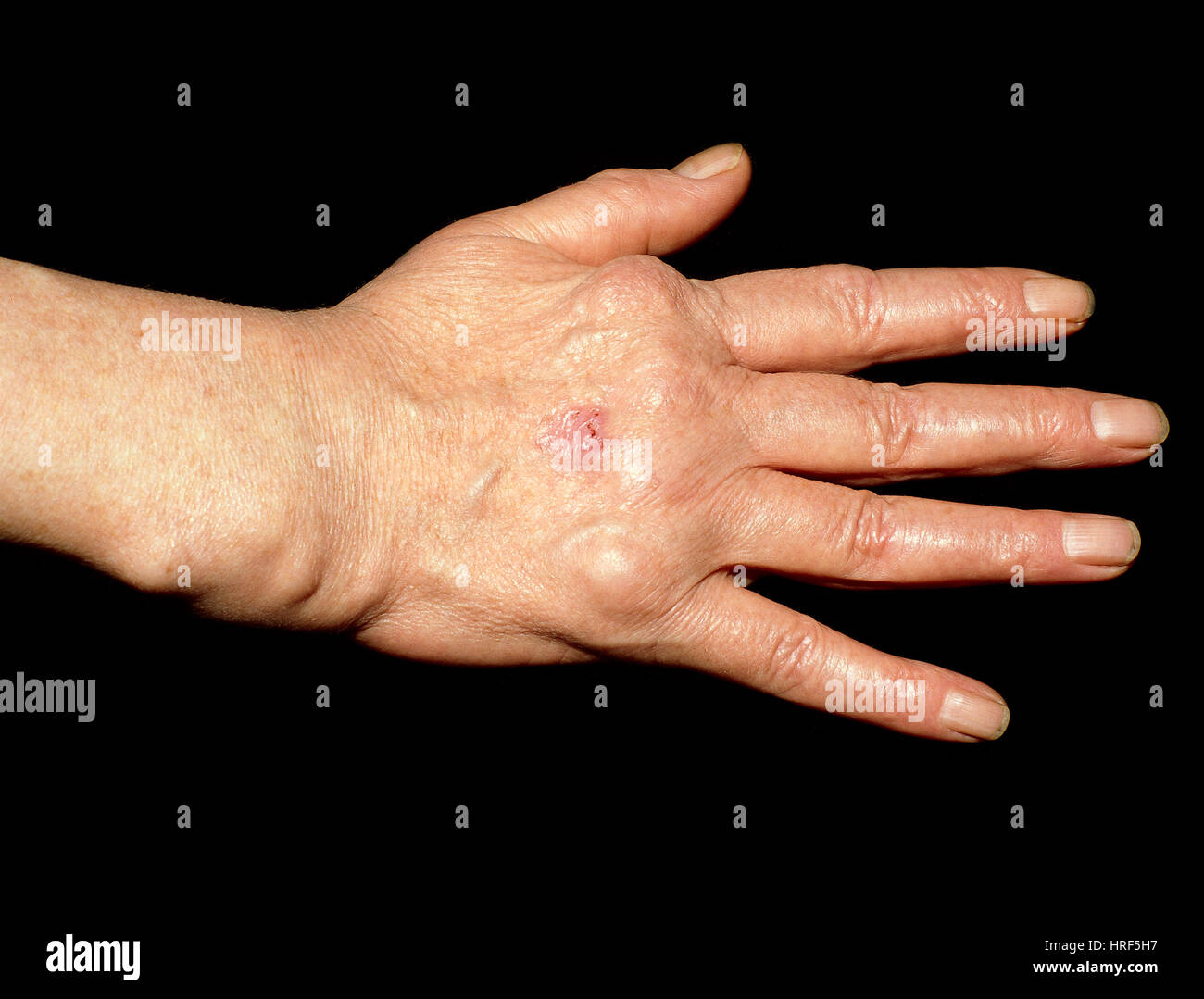 Endarteritis hi-res stock photography and images - Alamy